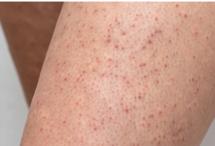 Queratosis pilaris: causas, síntomas y tratamientos BLOG » Nina Priorat